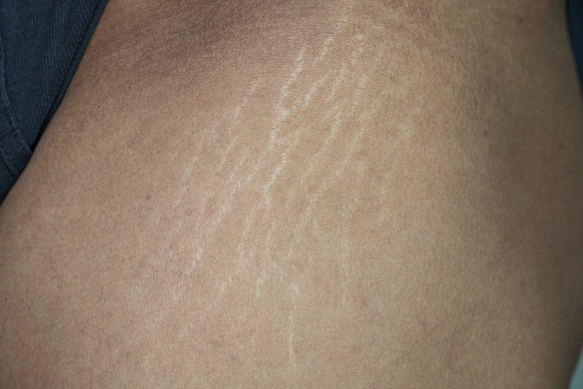 lavera Naturkosmetik | Cellulite und Dehnungsstreifen